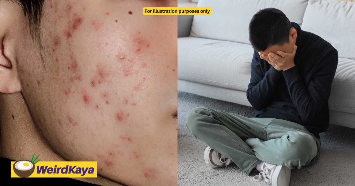 'They Called Me Pimples Boy' - M'sian Opens Up About Being Bullied In ...